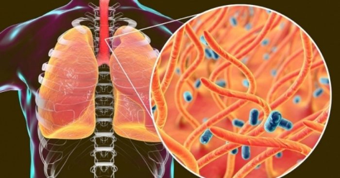 Whooping cough evolving to beat antibiotics and possibly vaccine