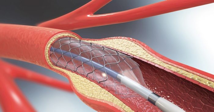 Stent design and strategy | Sydney Vascular Modelling Group - UNSW Sydney